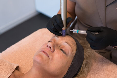 Littekens behandelen | Microneedling Anti Aging | LE MASQUE